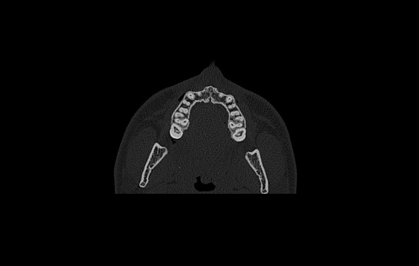 CT Axial Face Anatomy | CaseStacks.com