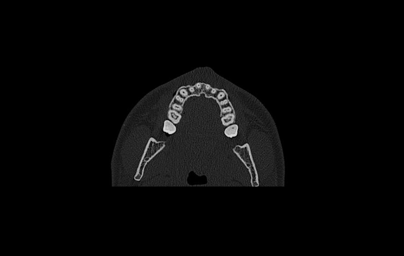 CT Axial Face Anatomy | CaseStacks.com