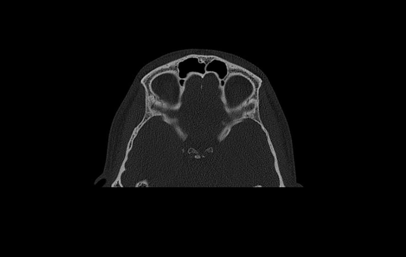 CT Axial Face Anatomy | CaseStacks.com