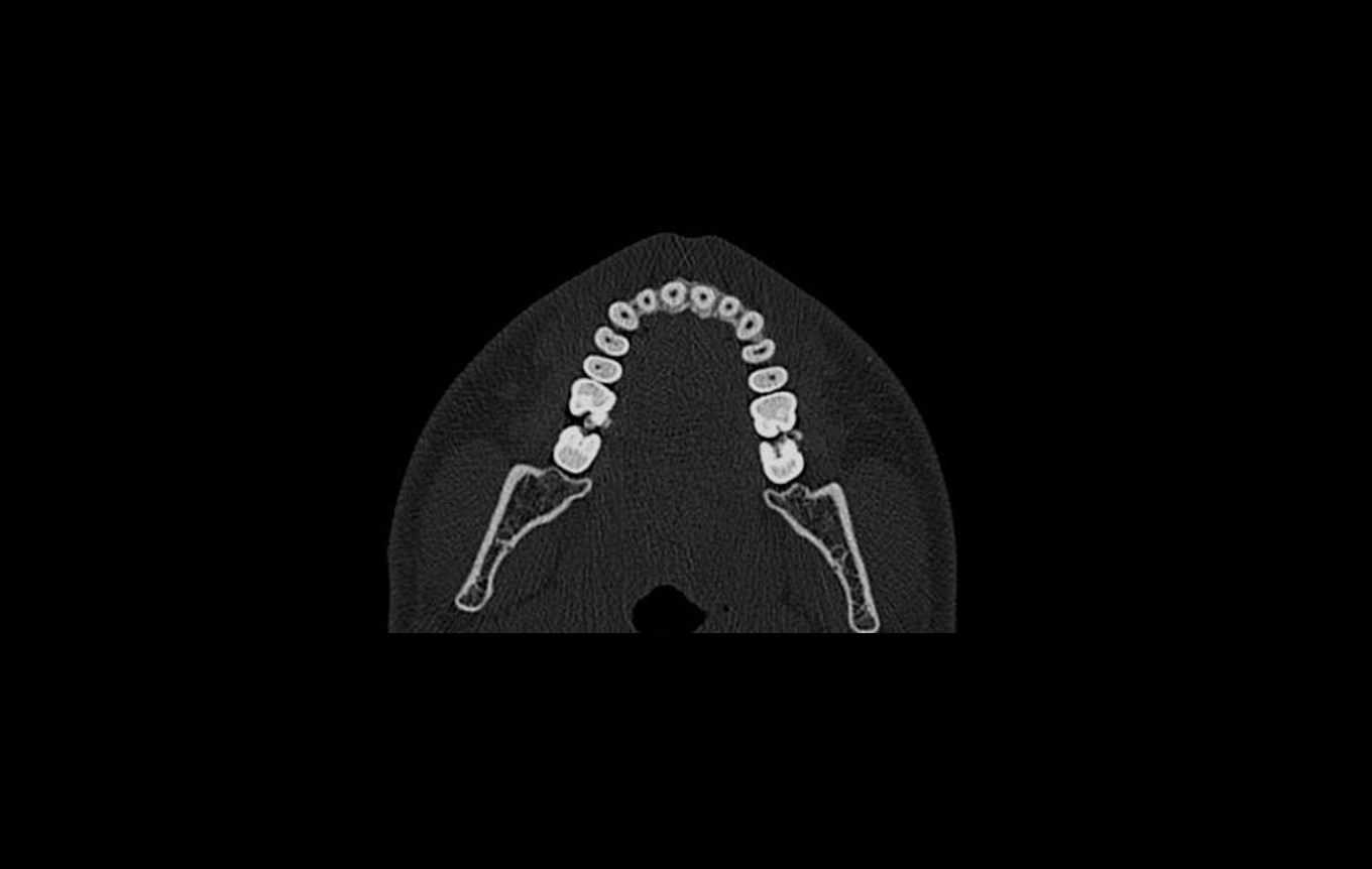 CT Axial Face Anatomy | CaseStacks.com
