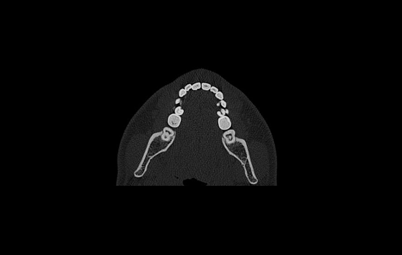 CT Axial Face Anatomy | CaseStacks.com