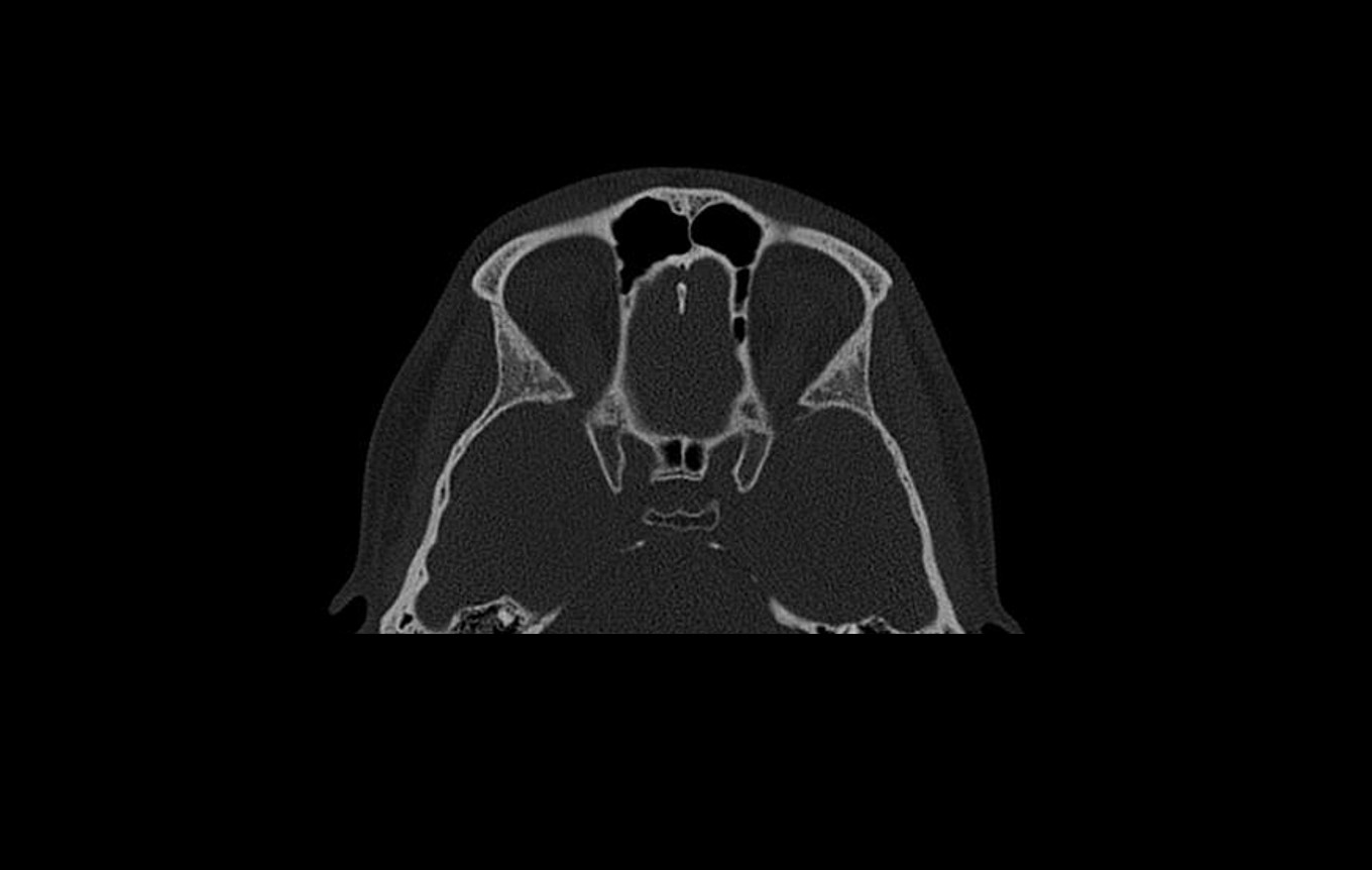 CT Axial Face Anatomy | CaseStacks.com