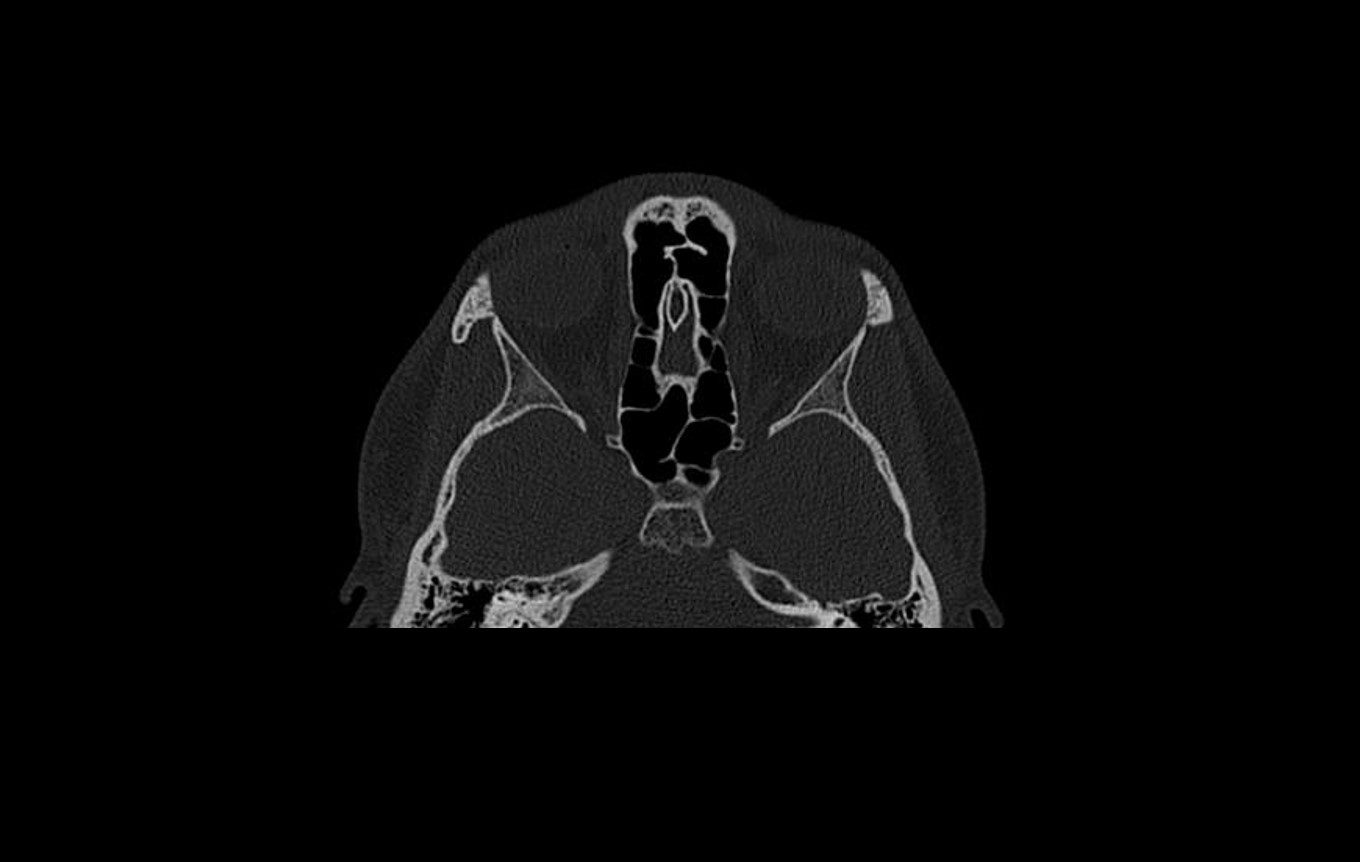 CT Axial Face Anatomy | CaseStacks.com