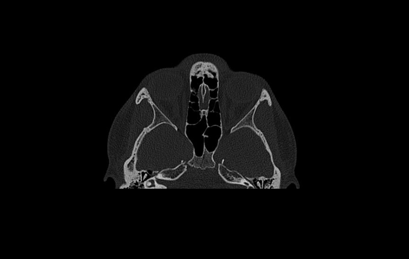 CT Axial Face Anatomy | CaseStacks.com