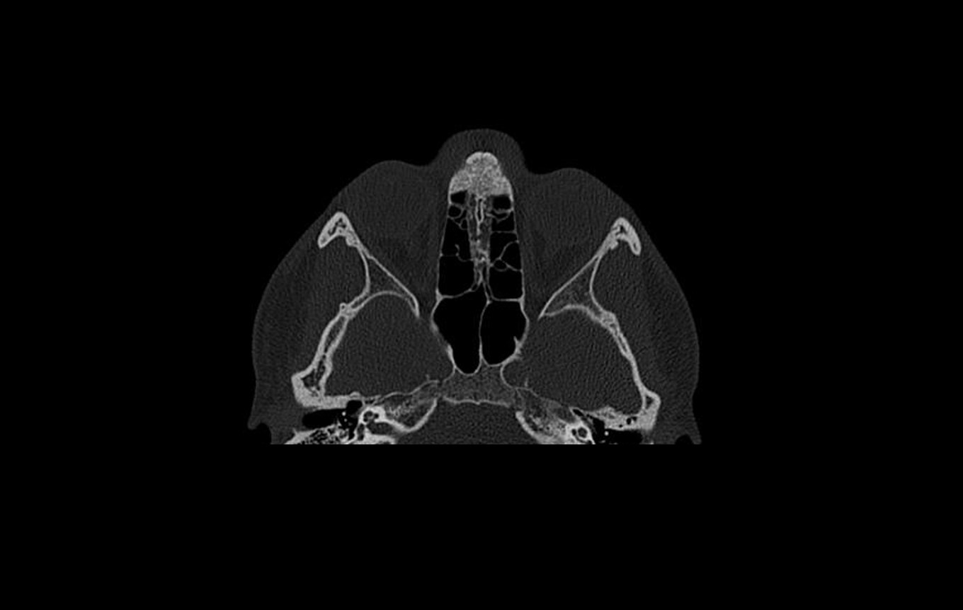 CT Axial Face Anatomy | CaseStacks.com