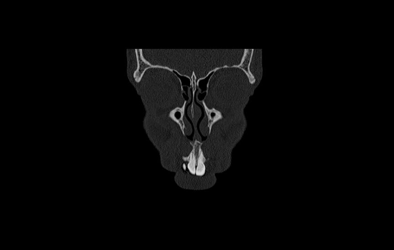 Coronal Face CT Anatomy | CaseStacks.com