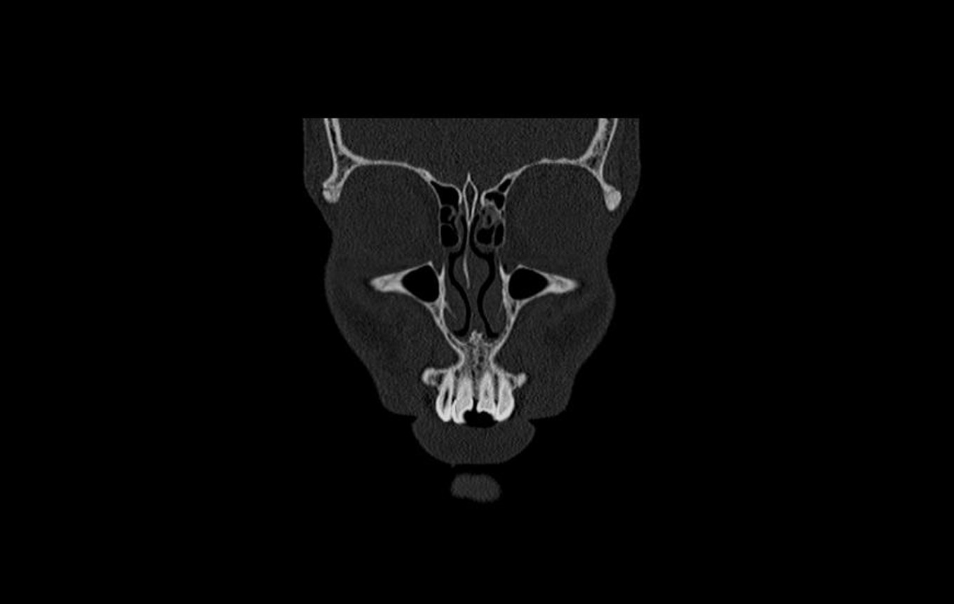 Coronal Face CT Anatomy | CaseStacks.com