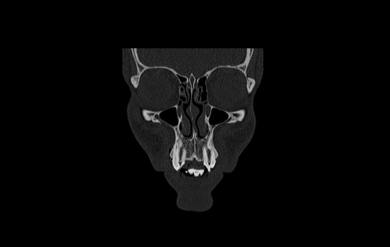 Coronal Face CT Anatomy | CaseStacks.com