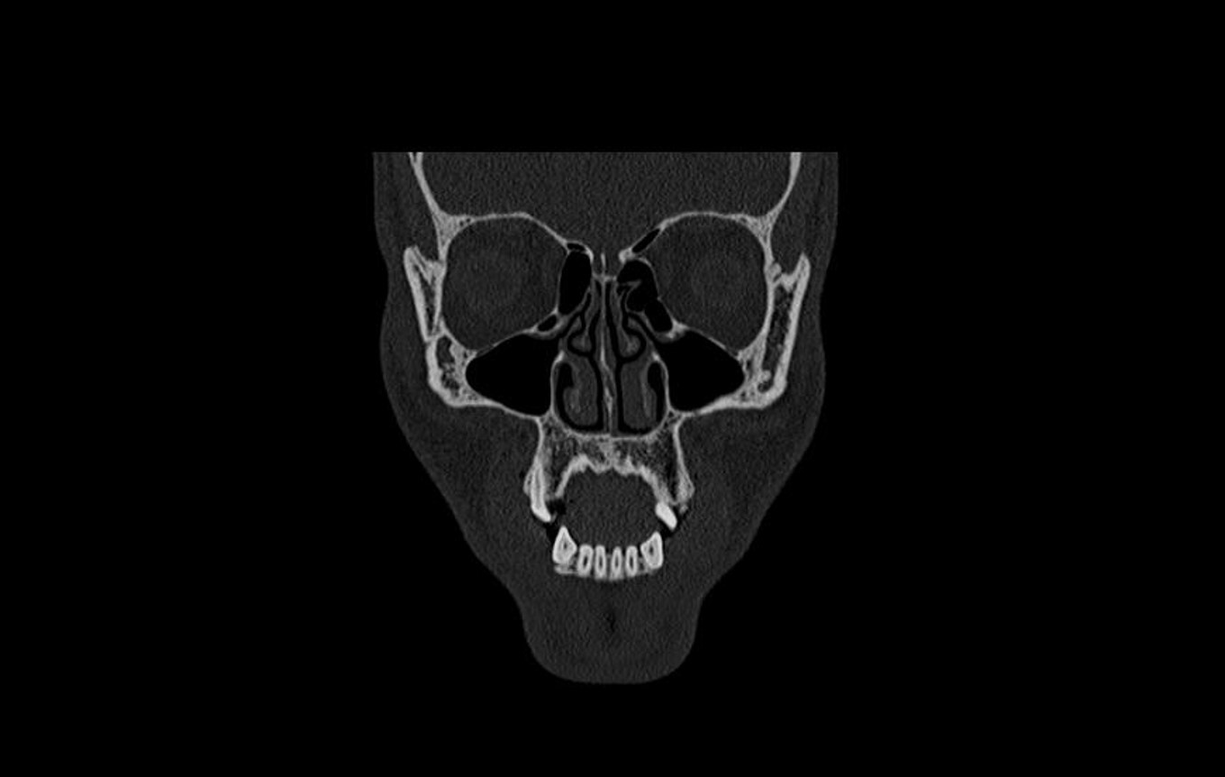 Coronal Face CT Anatomy | CaseStacks.com