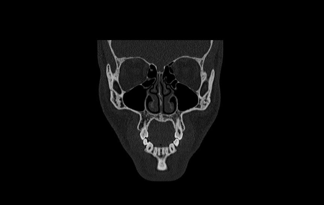 Coronal Face CT Anatomy | CaseStacks.com