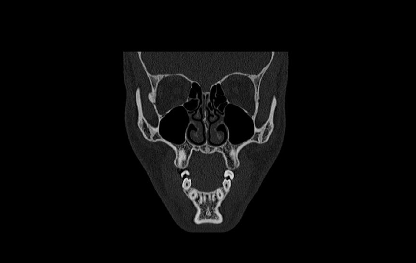 Coronal Face CT Anatomy | CaseStacks.com