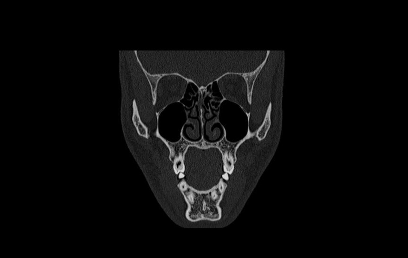 Coronal Face CT Anatomy | CaseStacks.com