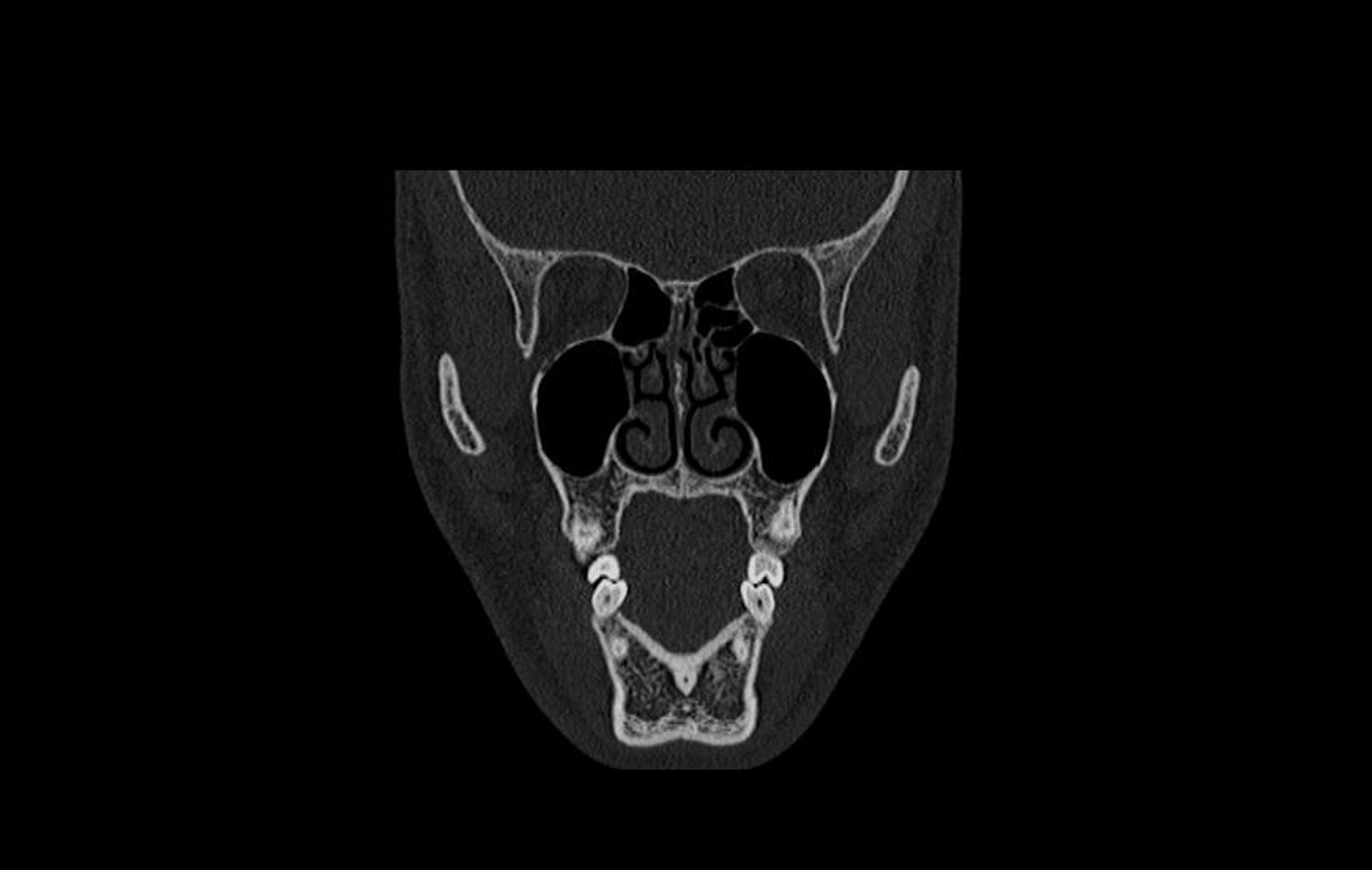 Coronal Face CT Anatomy | CaseStacks.com