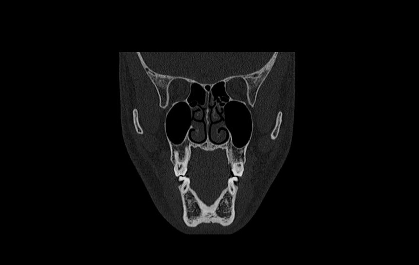 Coronal Face CT Anatomy | CaseStacks.com