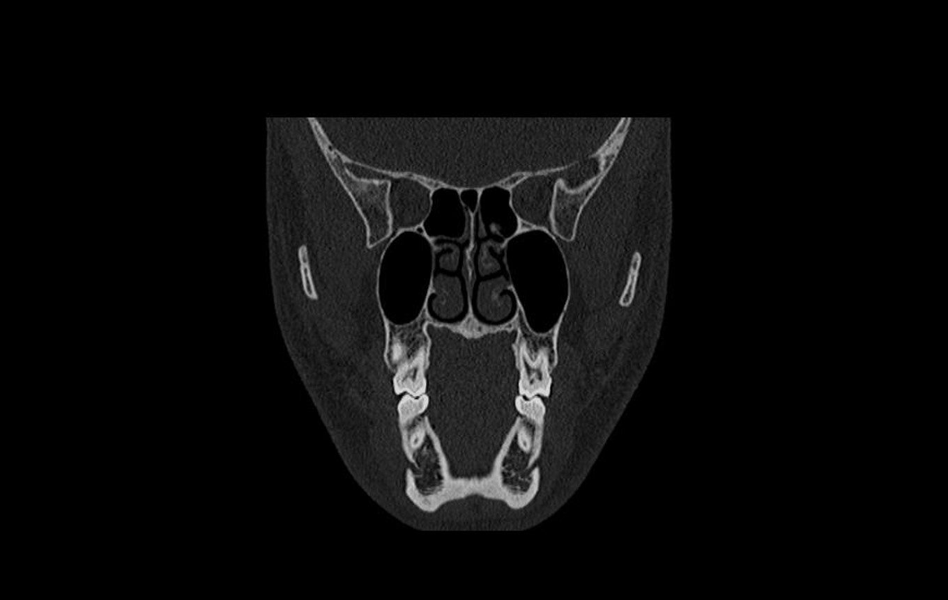 Coronal Face CT Anatomy | CaseStacks.com