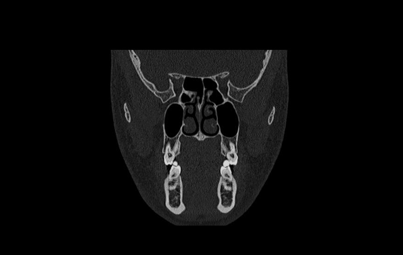 Coronal Face CT Anatomy | CaseStacks.com
