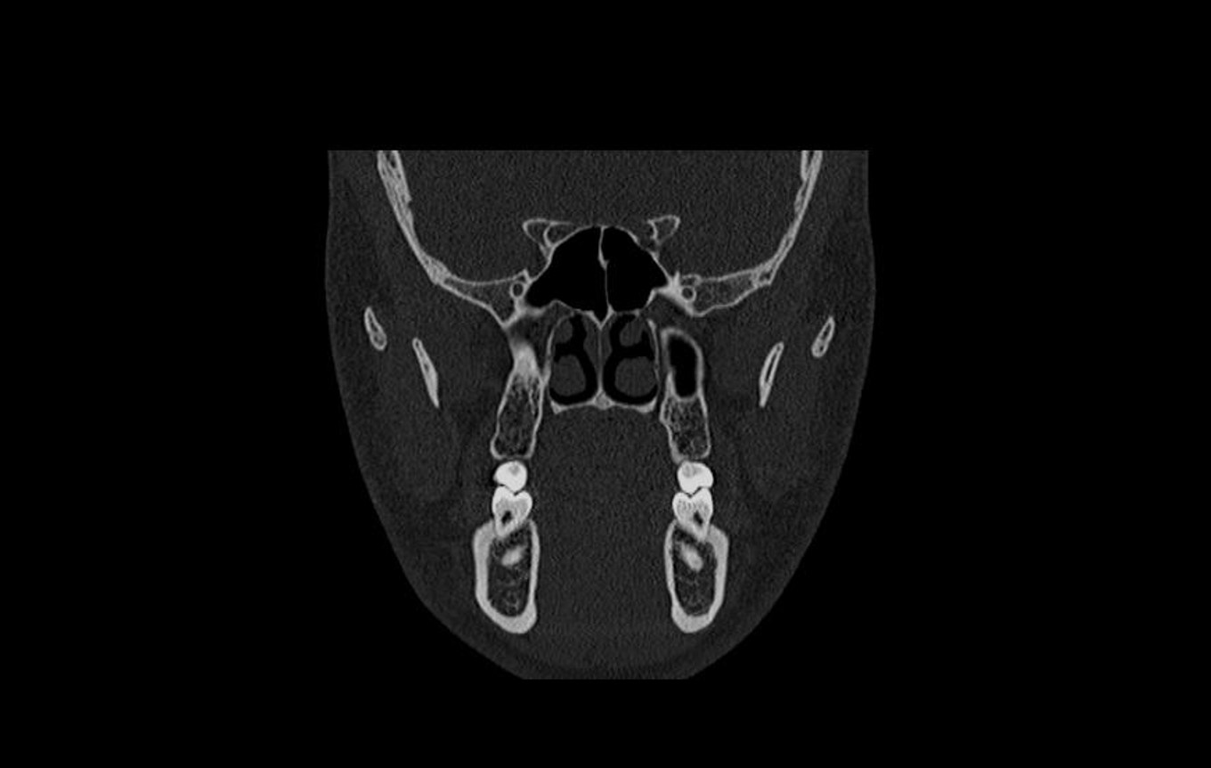 Coronal Face CT Anatomy | CaseStacks.com