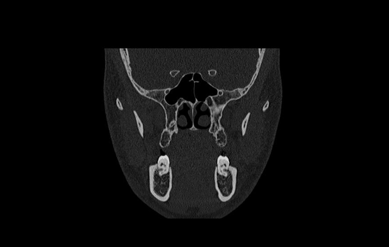 Coronal Face CT Anatomy | CaseStacks.com