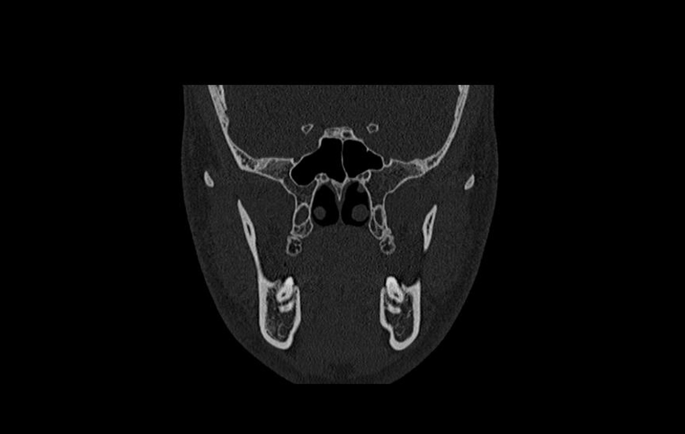 Coronal Face CT Anatomy | CaseStacks.com