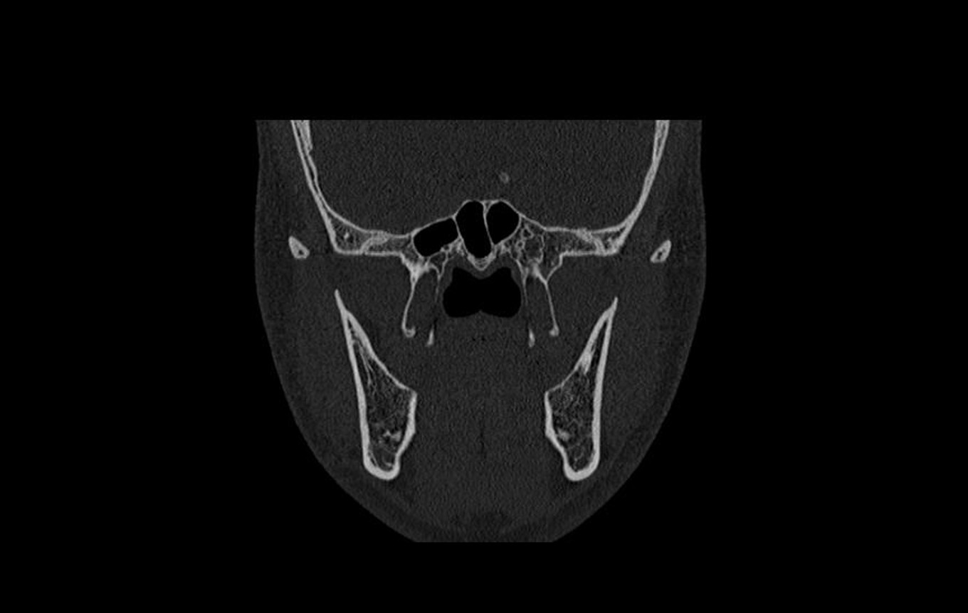 Coronal Face CT Anatomy | CaseStacks.com