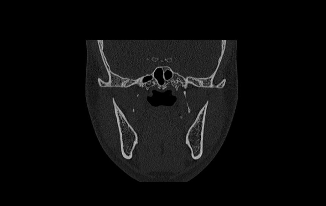 Coronal Face CT Anatomy | CaseStacks.com