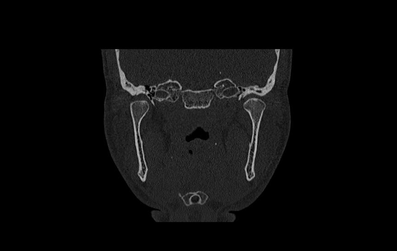 Coronal Face CT Anatomy | CaseStacks.com