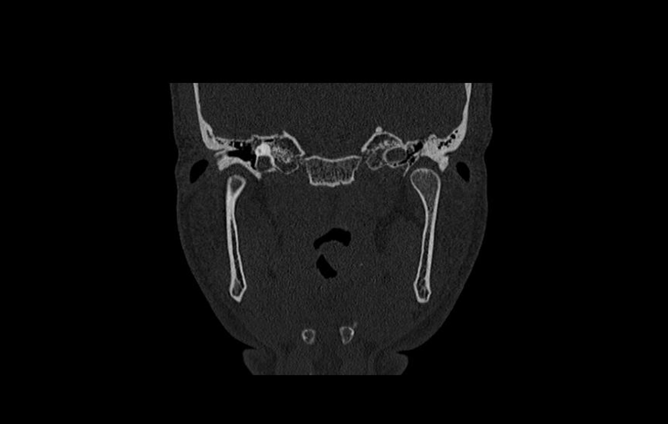 Coronal Face CT Anatomy | CaseStacks.com