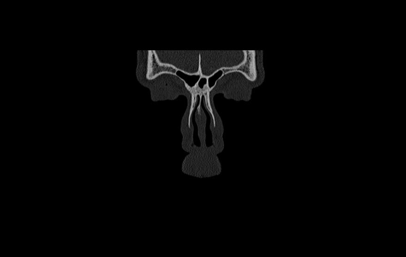 Coronal Face CT Anatomy | CaseStacks.com