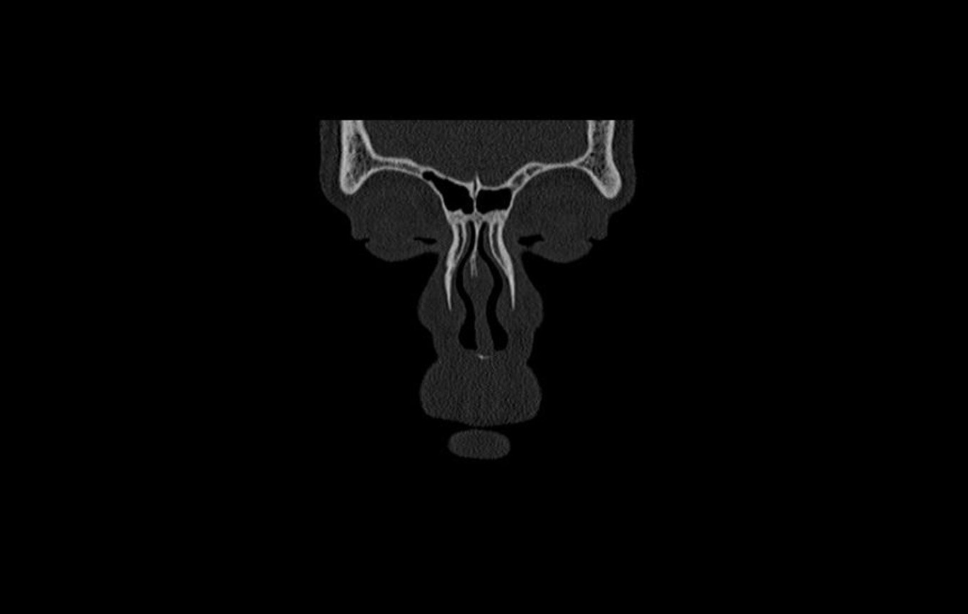 Coronal Face CT Anatomy | CaseStacks.com