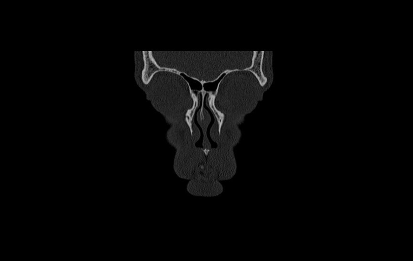 Coronal Face CT Anatomy | CaseStacks.com