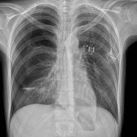 chest radiograph Archives - CaseStacks.com
