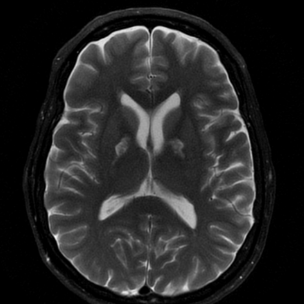 CaseStacks.com - Neuro MRI