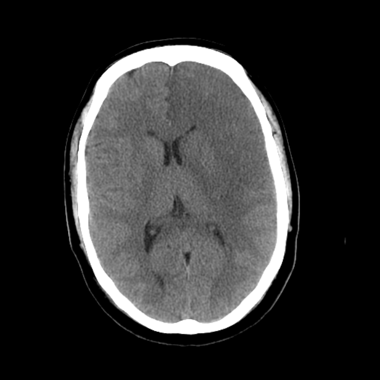 CaseStacks.com - Nontraumatic Head CT Cases