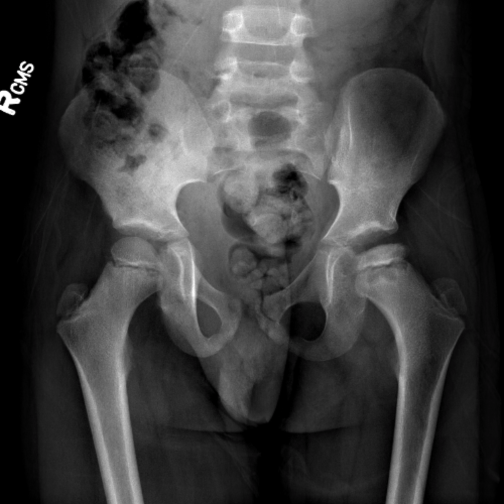 CaseStacks.com - Pediatric Pelvis & Hip Radiograph Cases