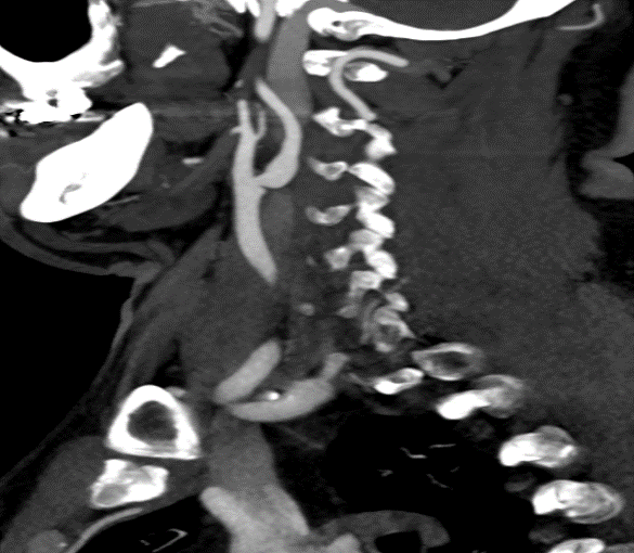 CaseStacks.com — Carotid Web