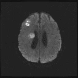 CaseStacks.com - Nocardiosis