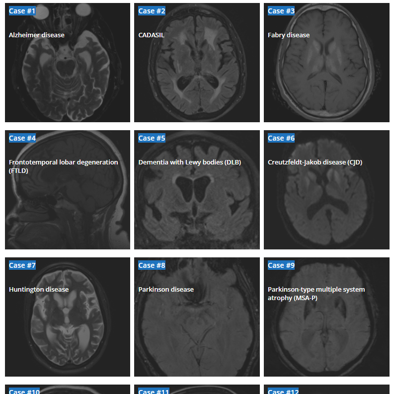 CaseStacks.com - Neurodegenerative Neurodegenerative Course